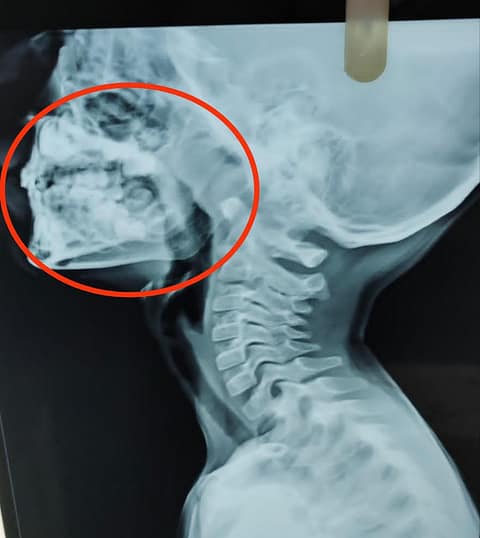 Adenoid - Practical Insights For Optimal Pediatric Health